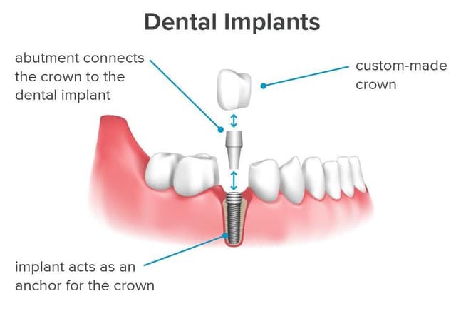 Tooth N Implants Dental Clinic Kompally | Best Dentist in Kompally ...